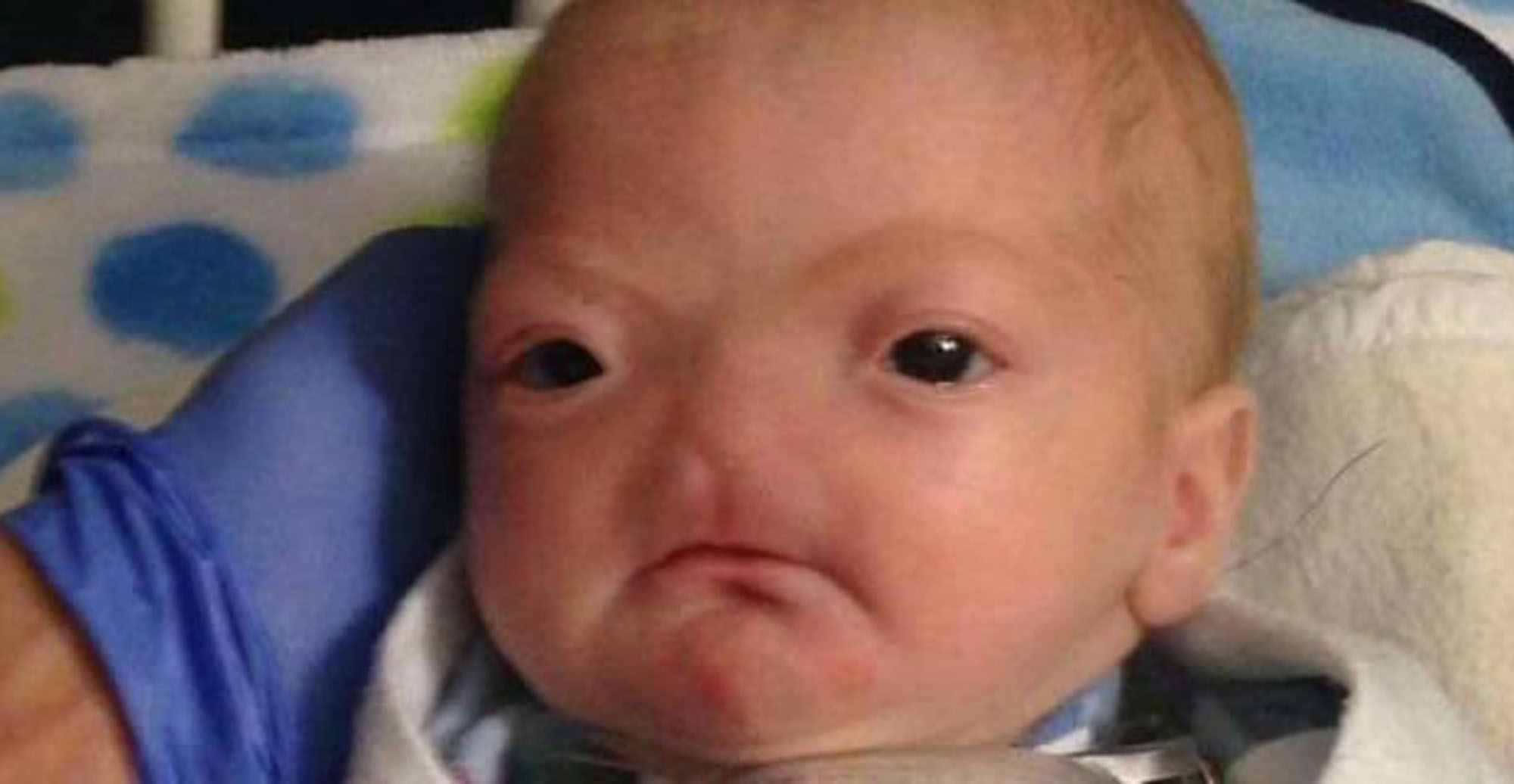 Meet the Miracle Baby Born Without a Nose
